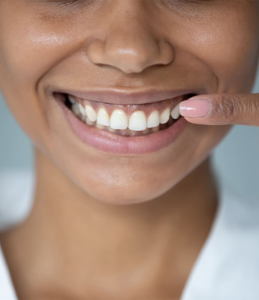 Composite Bonding Amersham - Face Teeth Smile